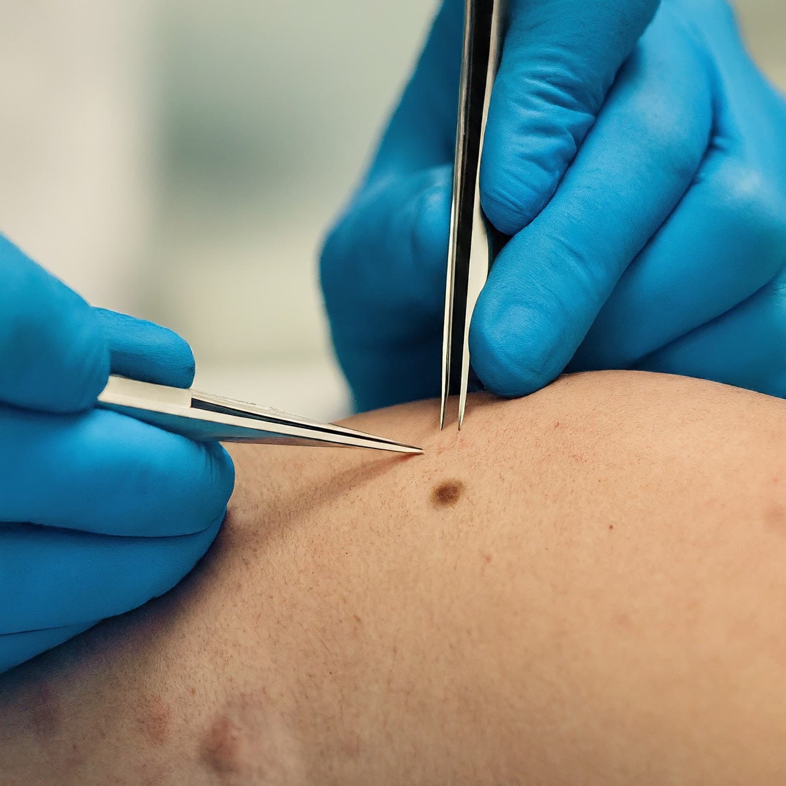 Cuando la medicina funciona: la importancia de la biopsia en el ...